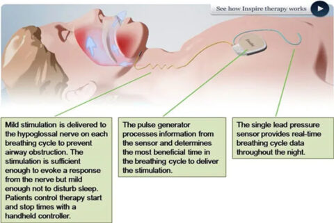 Inspire Hypoglossal Nerve Stimulator - International Surgical Sleep Society