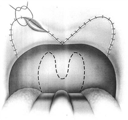 Palatal Z-Plasty - International Surgical Sleep Society